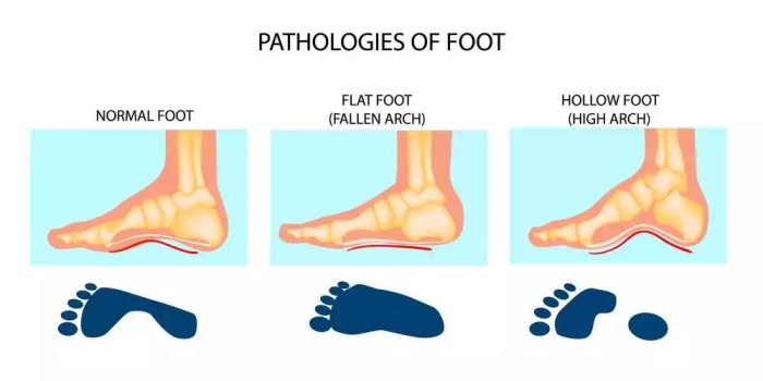 How to determine foot arch type | Orthotics Insoles & EVA Supplier ...