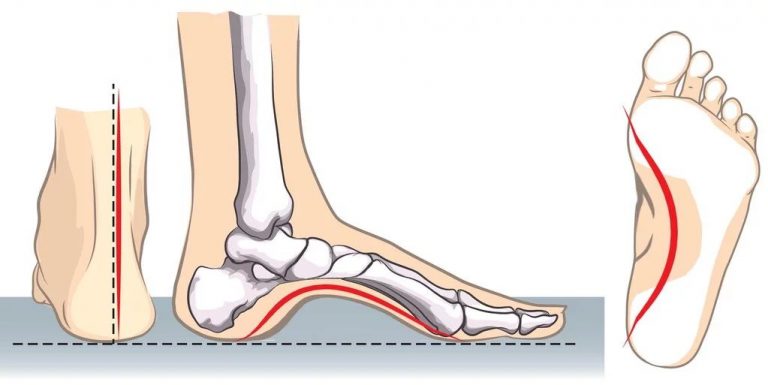How To Determine Foot Arch Type Eva Orthotic Insoles Manufacturer Ideastep