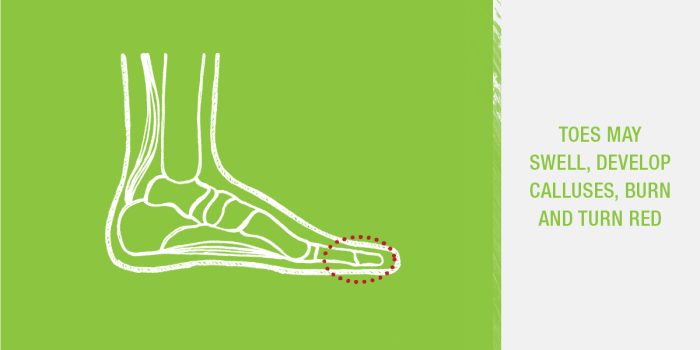 Hammer Toes Explained | Orthotics Insoles & EVA Supplier | Ideastep
