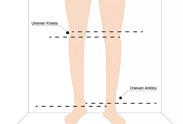 Leg Length Discrepancy Ideastep leg-length-discrepancy-ideastep